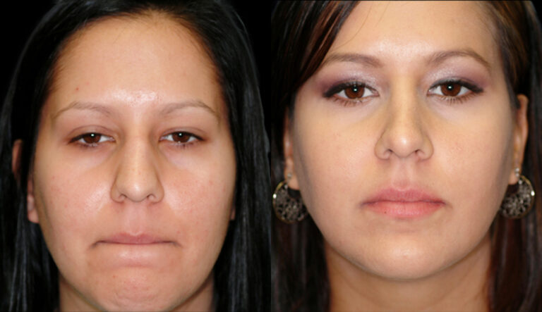 Atlanta Face Before and After Photos | Marietta Plastic Surgery Photo ...