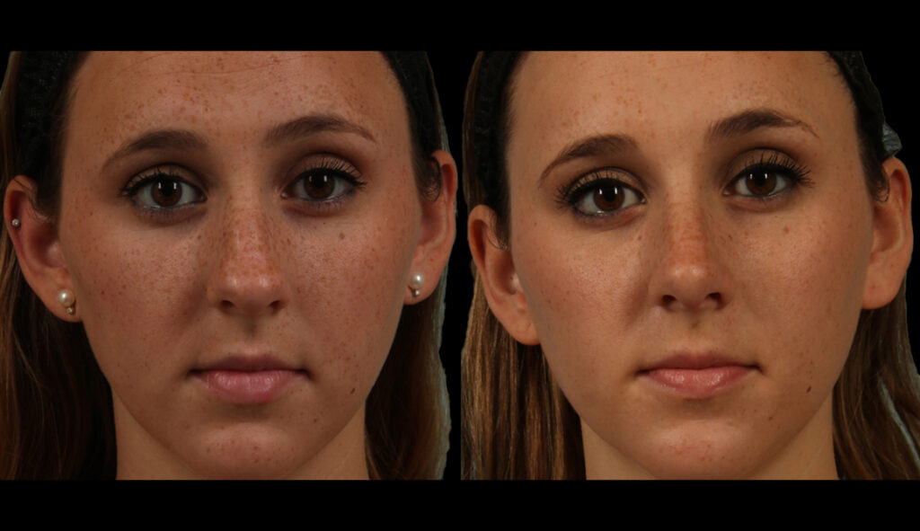 Atlanta Face Before and After Photos | Marietta Plastic Surgery Photo ...