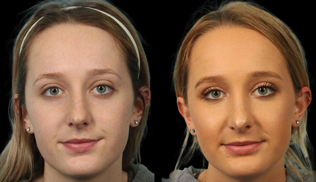 Atlanta Face Before and After Photos | Marietta Plastic Surgery Photo ...