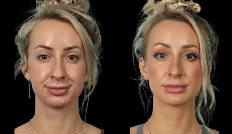 Atlanta Face Before and After Photos | Marietta Plastic Surgery Photo ...