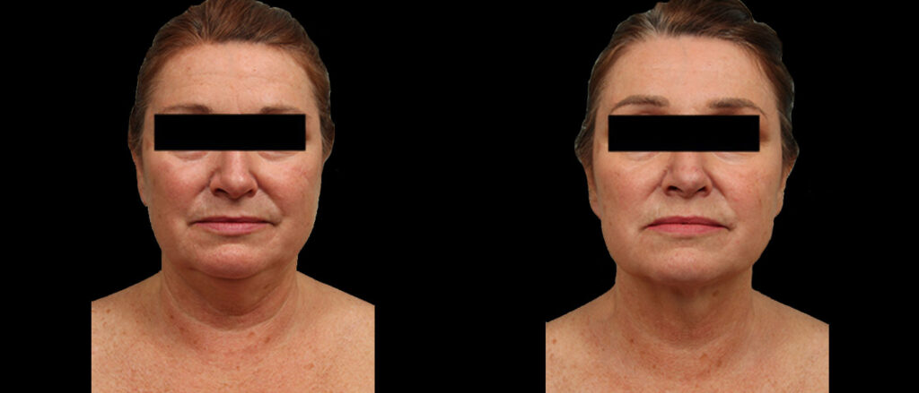 FaceTite Patient Case #5643 - Marietta Plastic Surgery