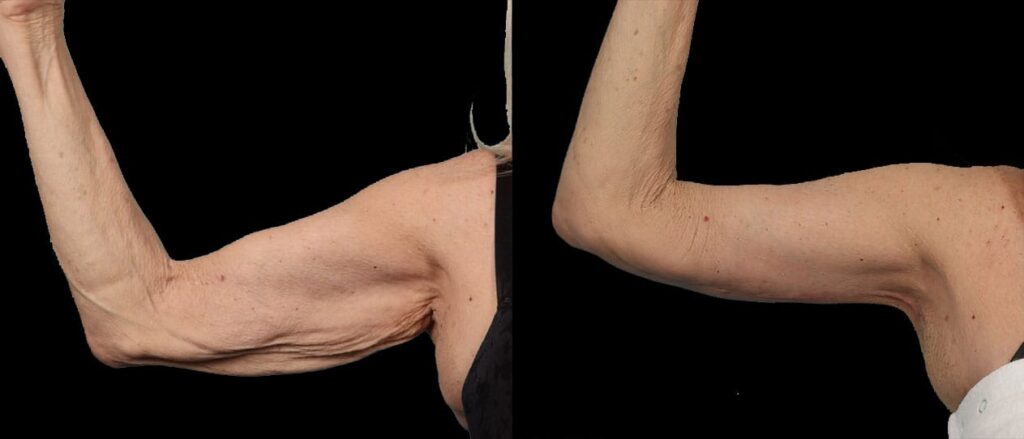 Brachioplasty Before & Afters - Marietta Plastic Surgery